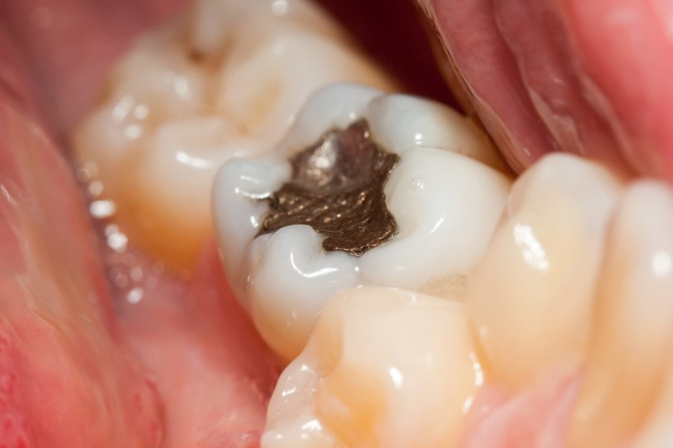 Six Facts about Cavities and Dental Fillings | Gallery Dental of Oakbrook